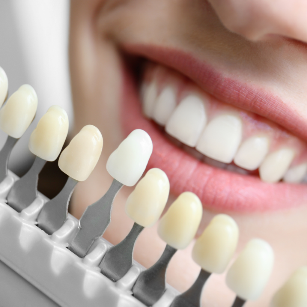 Blanqueamiento externo: Tipos - Clínica dental Gobela